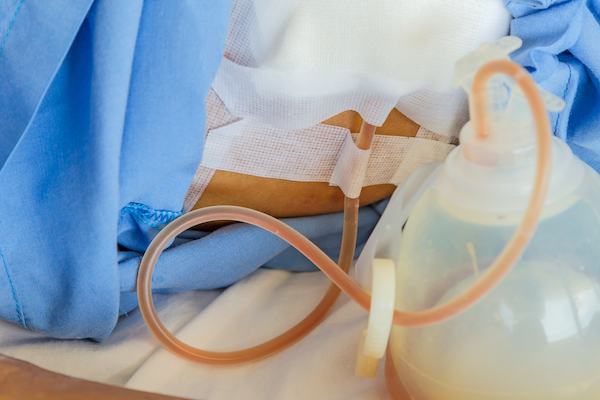 Why Do We Still Use Drains in Plastic Surgery?